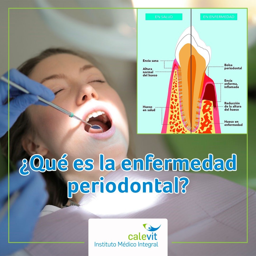 ¿Qué es la enfermedad periodontal? - Calevit